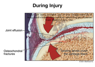 Breaking Down Traumatic Arthritis