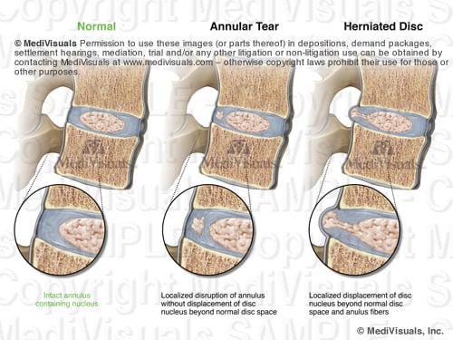 Annular Tears and Fissures (Intervertebral Disc Pathology, Part 2 of 3)
