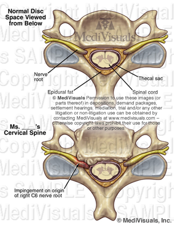 Understanding the Osteophyte/Disc Complex in Spinal Trauma