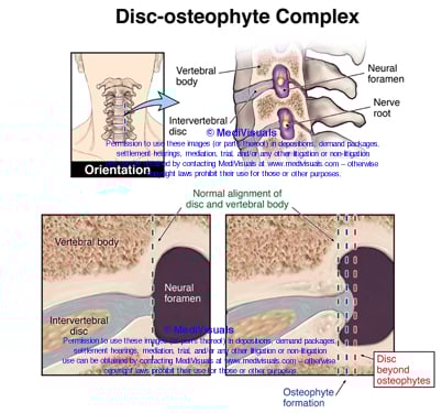 Disc-Osteophyte Complex Explained