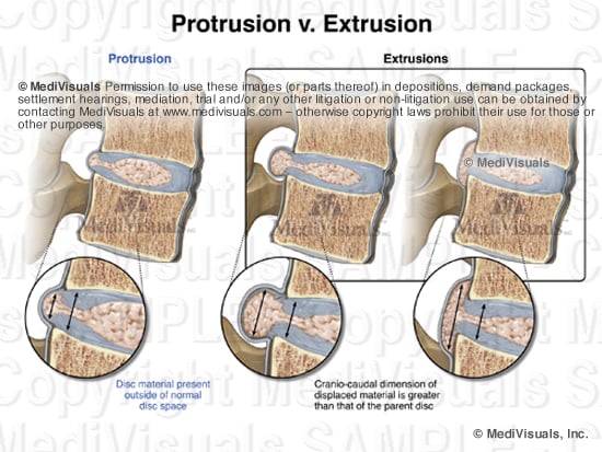 Protrusions Versus Extrusions (Intervertebral Disc Pathology, Part 3 of 3)